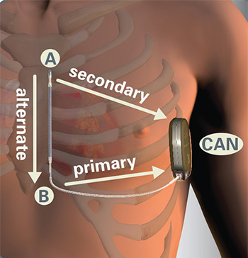 Subcutaneous ICD - Ballarat Cardiology